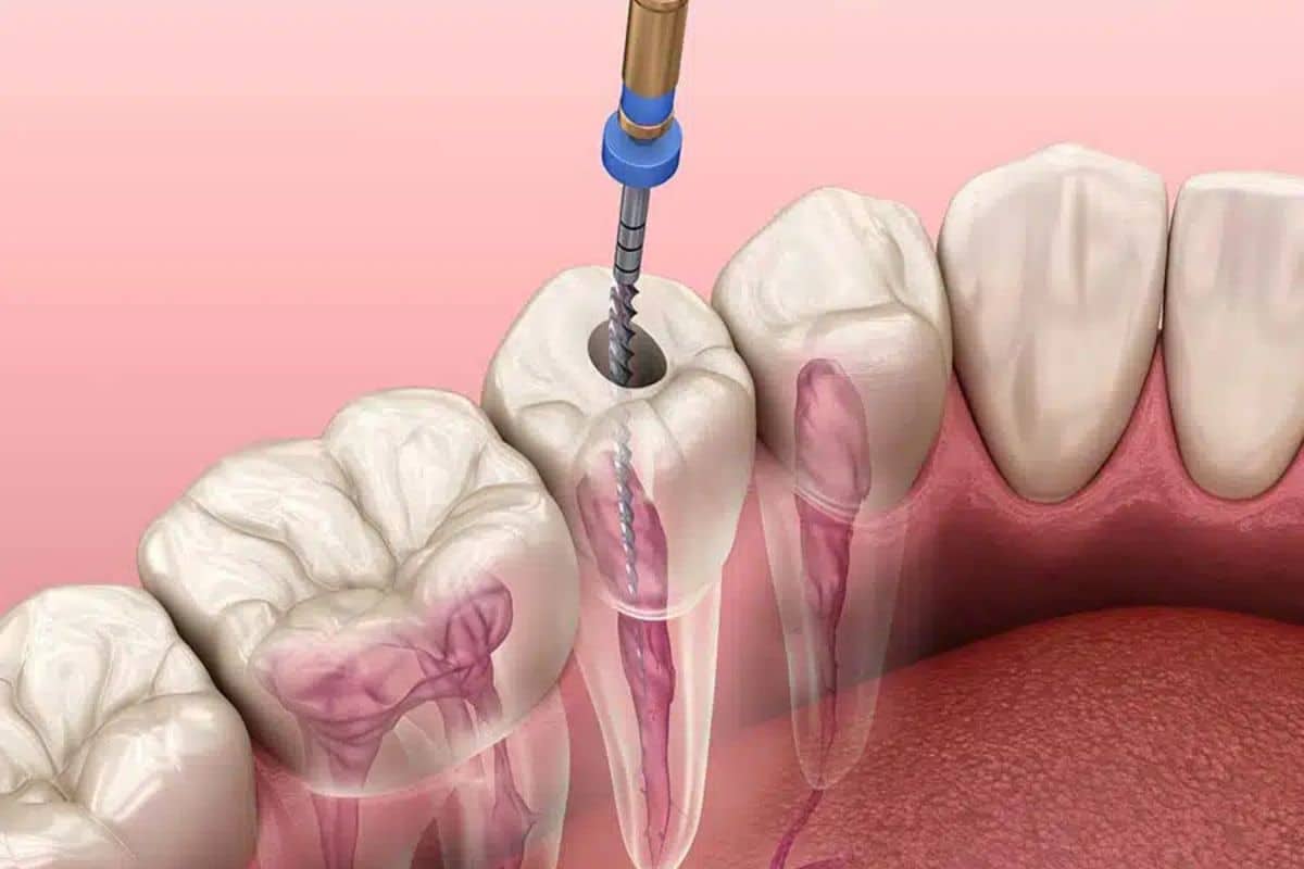 Kids’ Tooth Decay: Signs It’s Time for a Root Canal